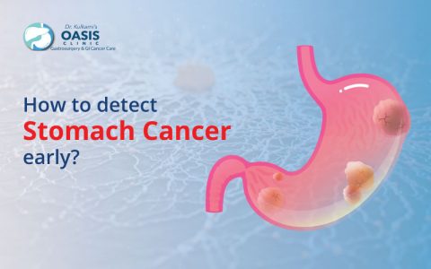 how to detect stomach cancer early? | Oasis Clinic