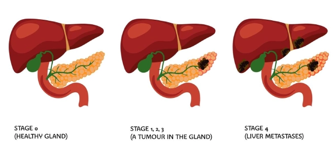 Modern Biomarkers Redefine Pancreatic Cancer Staging