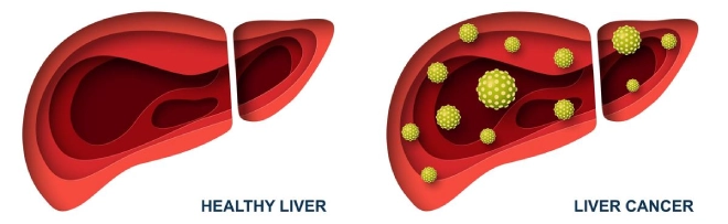 What causes Liver Cancer? Dr. Aditya Kulkarni - Oasis Clinic
