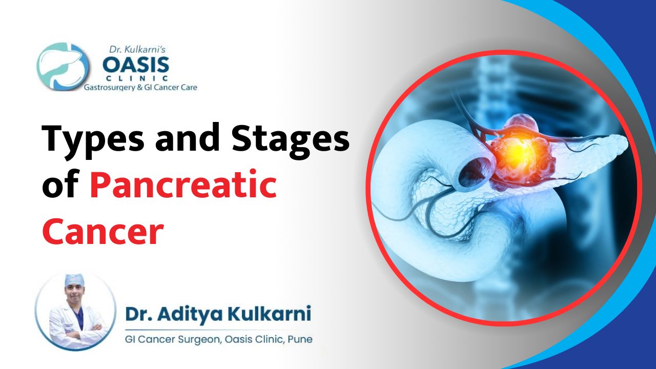 Pancreatic Cancer: A Closer Look at Its Types and Stages